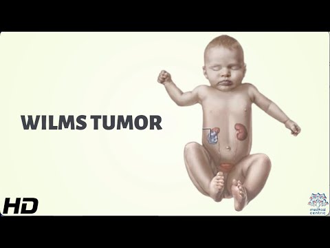 Nephroblastoma Pathology: Insights for Scientific Outreach