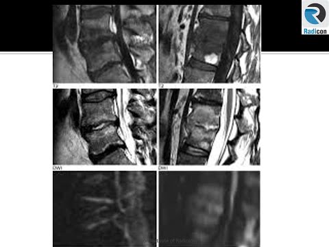 MRI Advances in Diagnosing Discitis and Its Implications